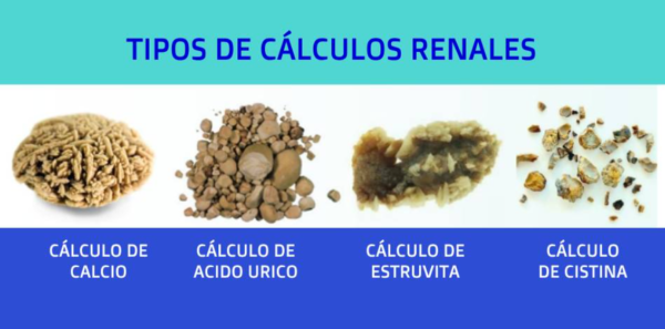 Litiasis Renal | Tienda Naturista